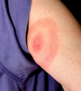 Lyme Disease Rash Photos: Early-Stage, Bull’s-Eye, and Atypical Rashes ...